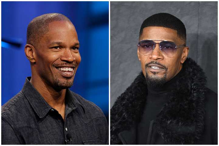 25 male hair transplant celebrities before and after (with photos ...